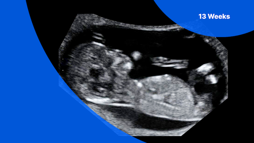 13 Weeks Pregnant Ultrasound: A Window into Your Baby's World - Mammy Cares