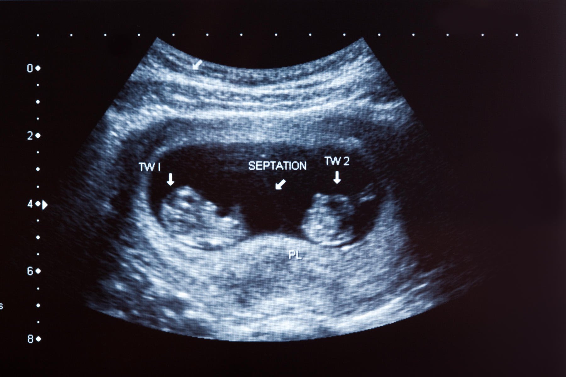 6 Weeks Pregnant Ultrasound Twins: A Comprehensive Guide - Mammy Cares