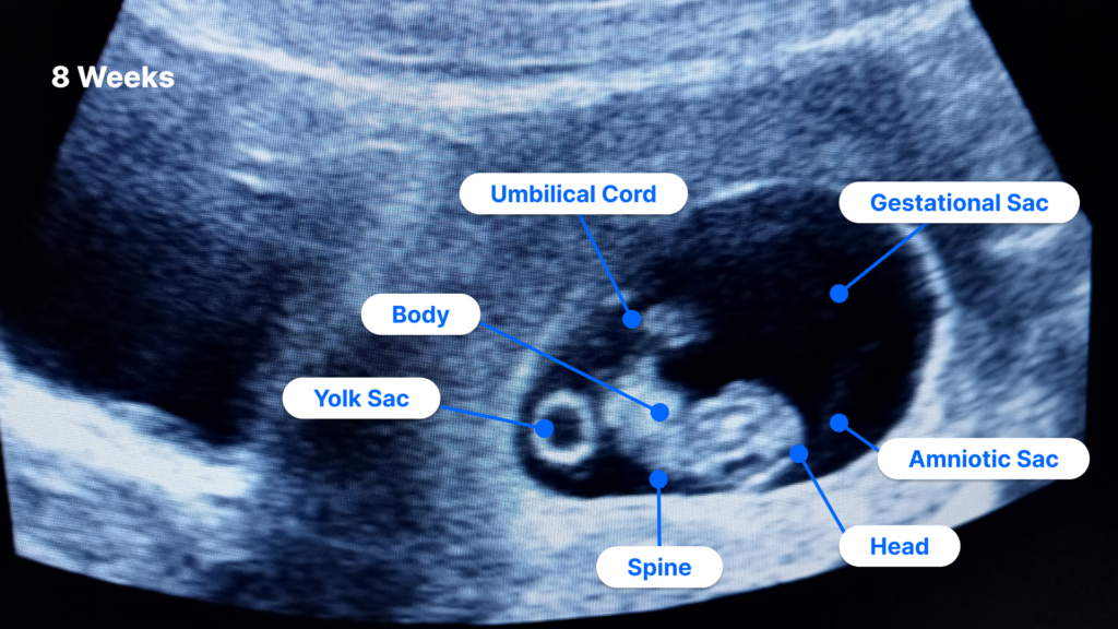 Images Of 8 Weeks Pregnant Ultrasound: A Visual Guide to Fetal Development - Mammy Cares